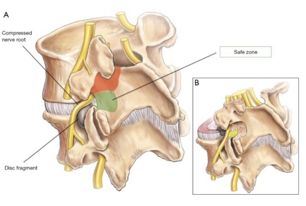Lateral Disc Herniations | NSPC Brain & Spine Surgery