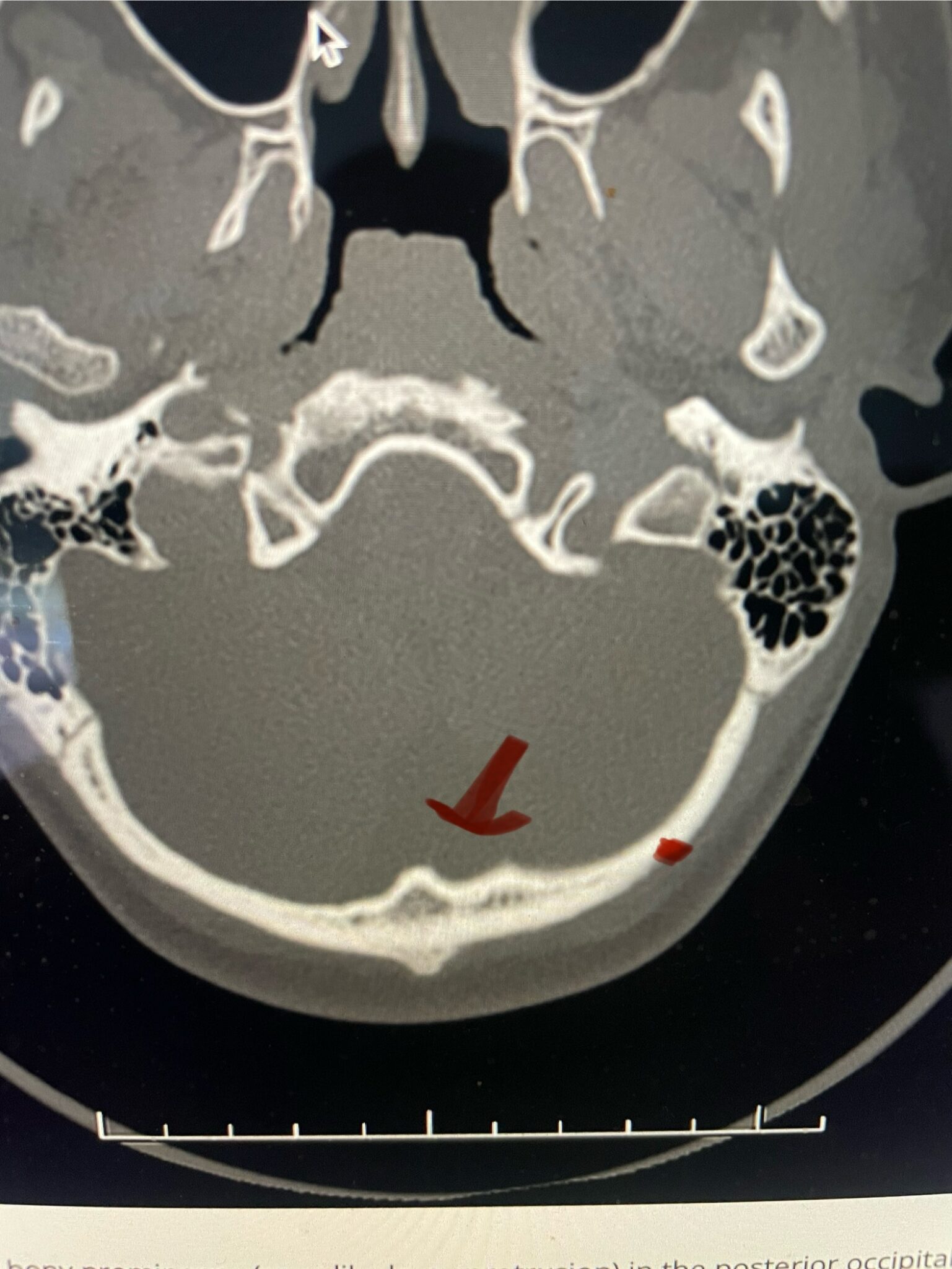SOMETIMES YOU HAVE TO CONNECT THE SKULL TO THE NECK | NSPC Brain ...