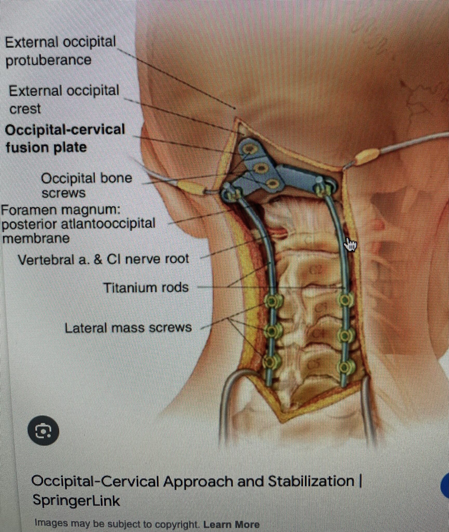 SOMETIMES YOU HAVE TO CONNECT THE SKULL TO THE NECK | NSPC Brain ...